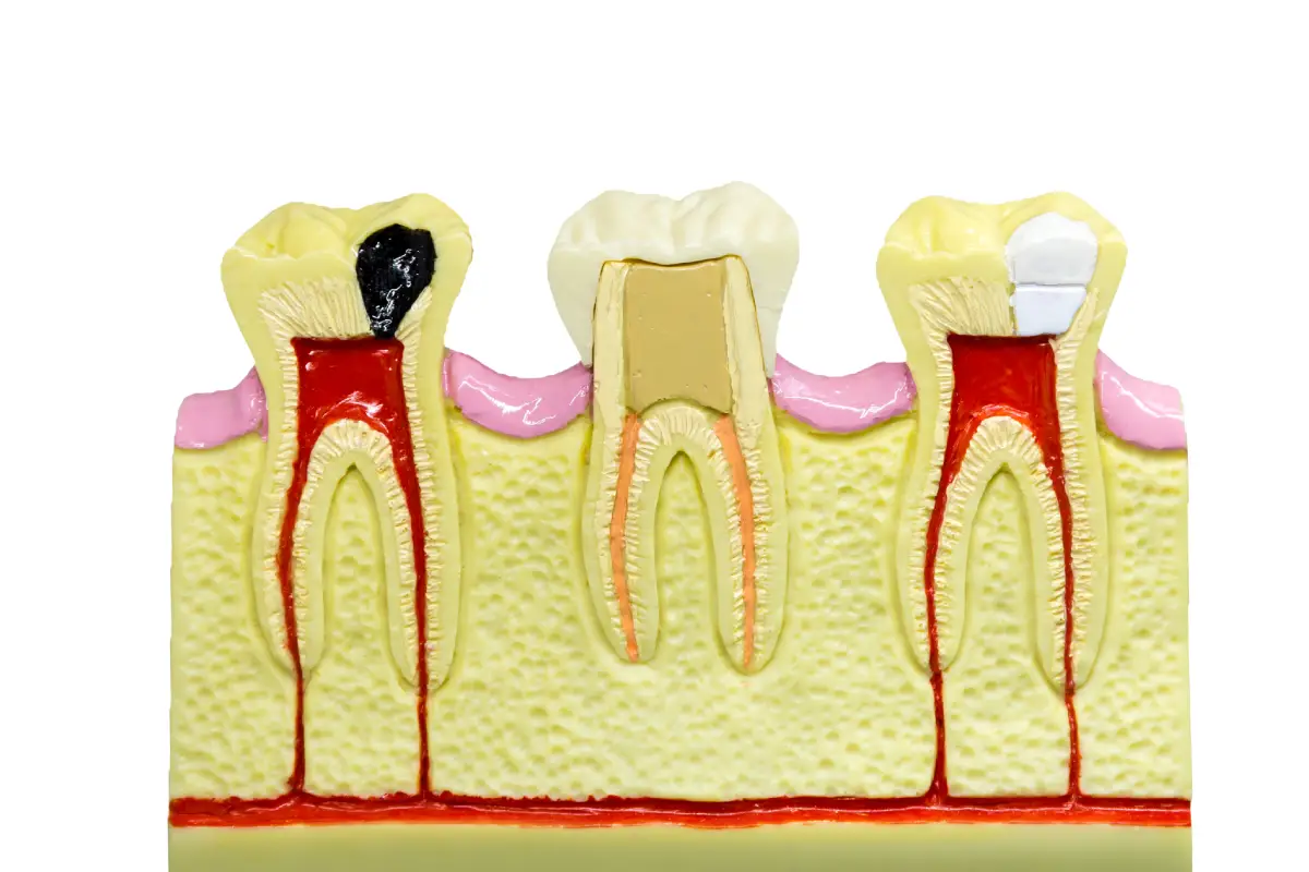 Rotten Teeth? Expert Solutions